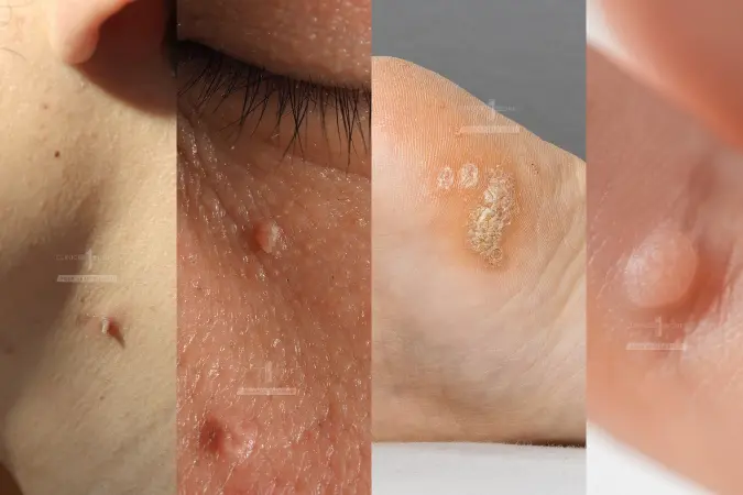 Wart Removal in Kathmandu, Nepal | Clinic One